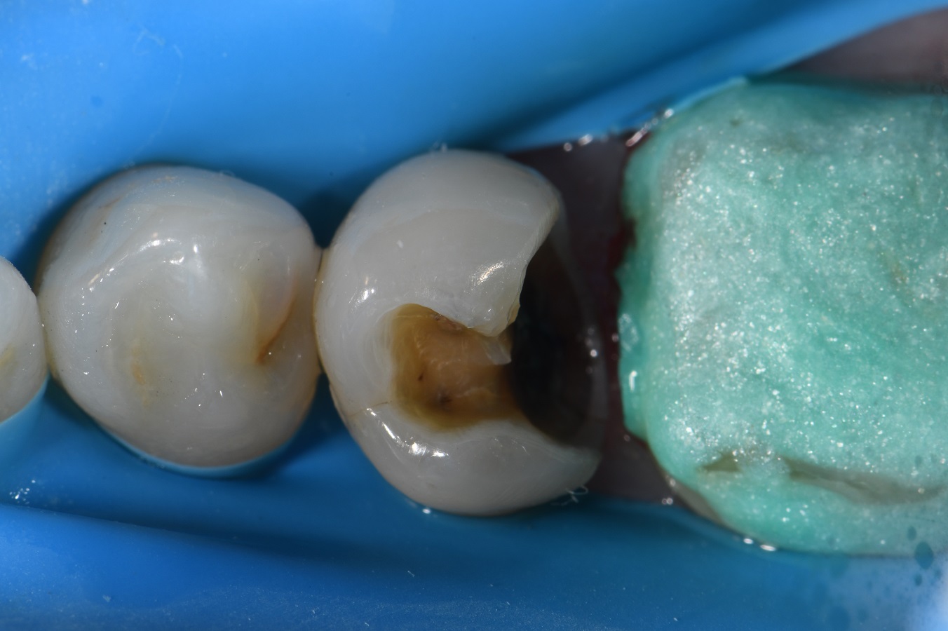 Matrix in Matrix Composite Resin Technique