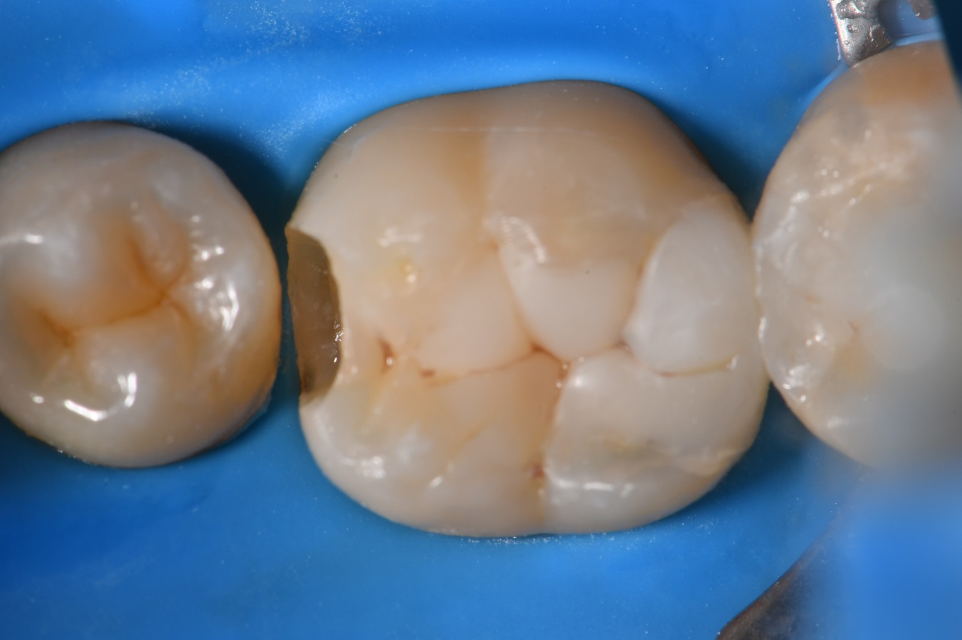 Composite Slot restoration Voco Grandio SO