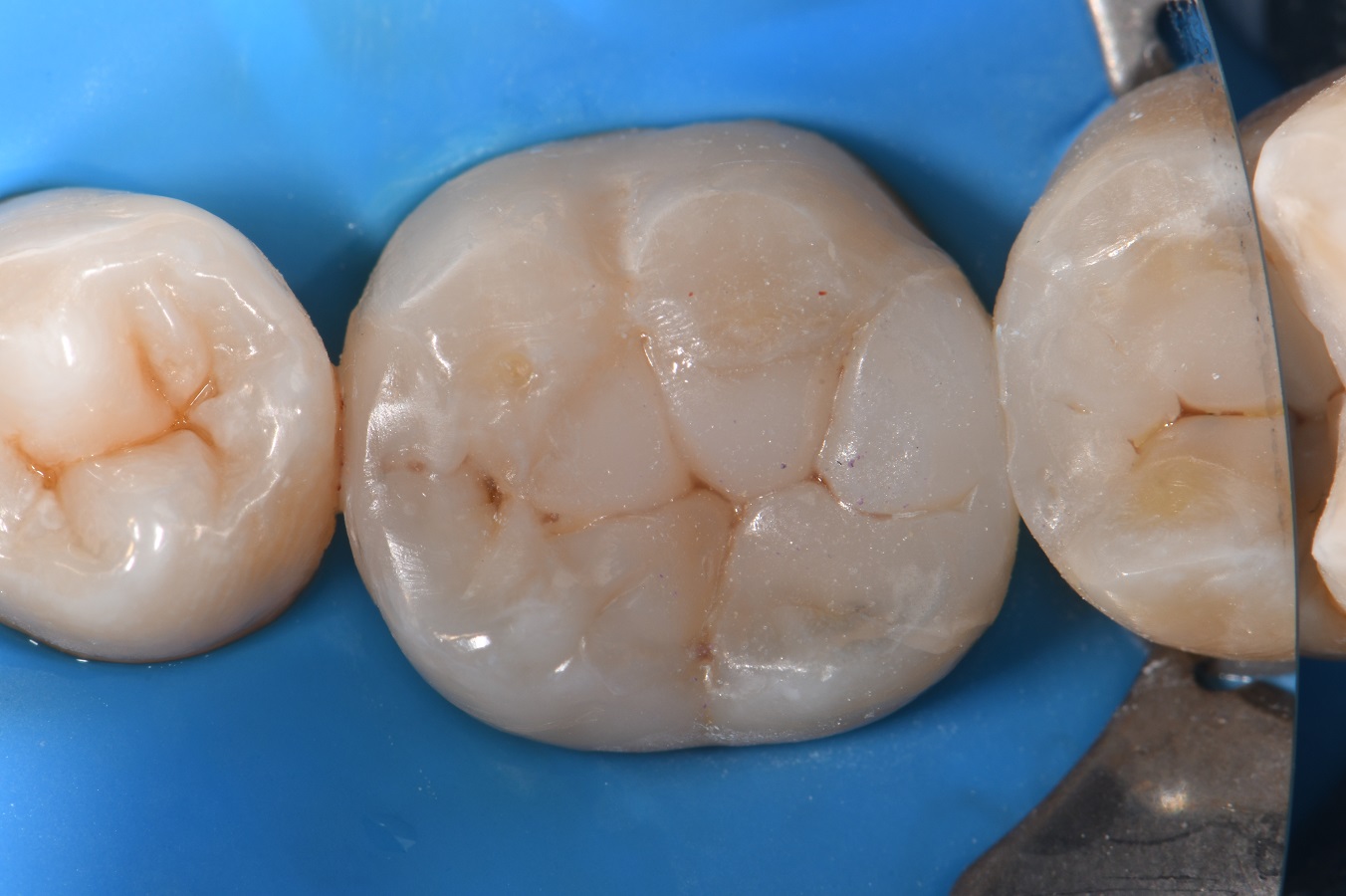 Composite Slot restoration Voco Grandio SO