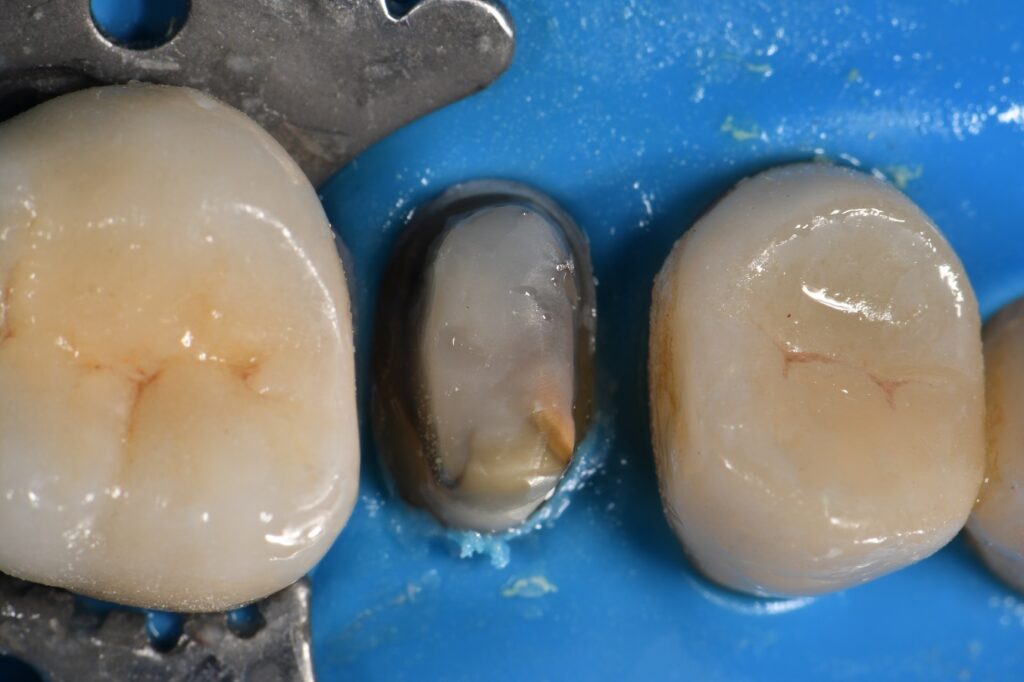 Reinforcing old Crowned Teeth Reinforcing old Crowned Teeth