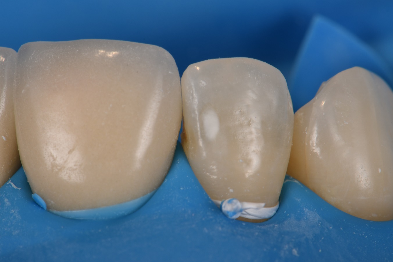 Class III caries and white spot removal