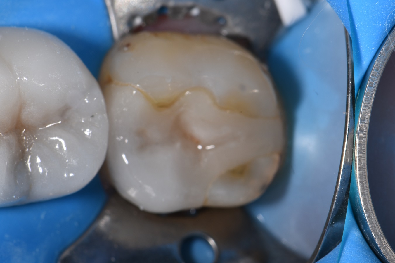 Bonded Dental Crowns