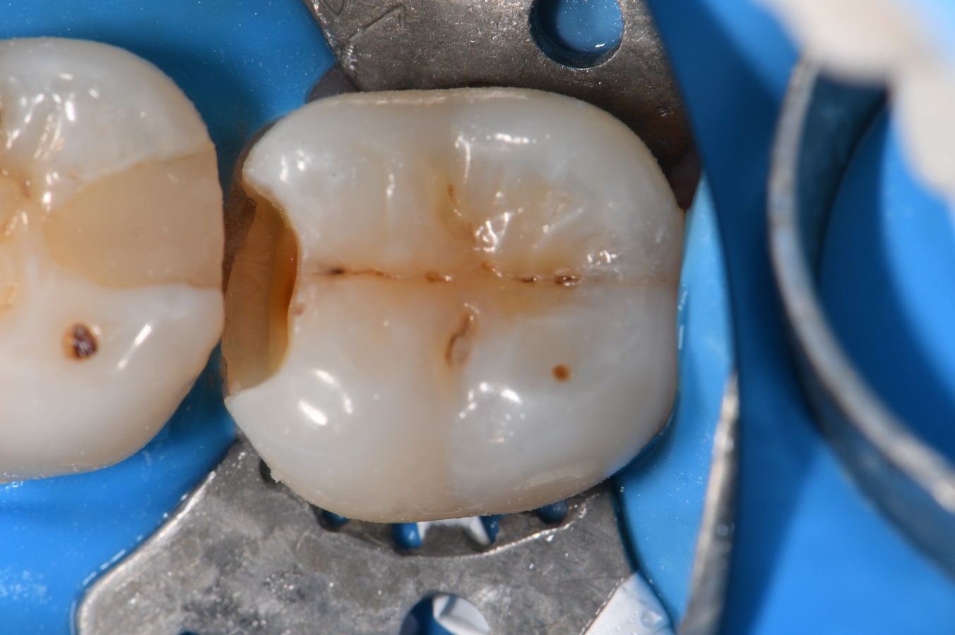 Slot Composite Restoration