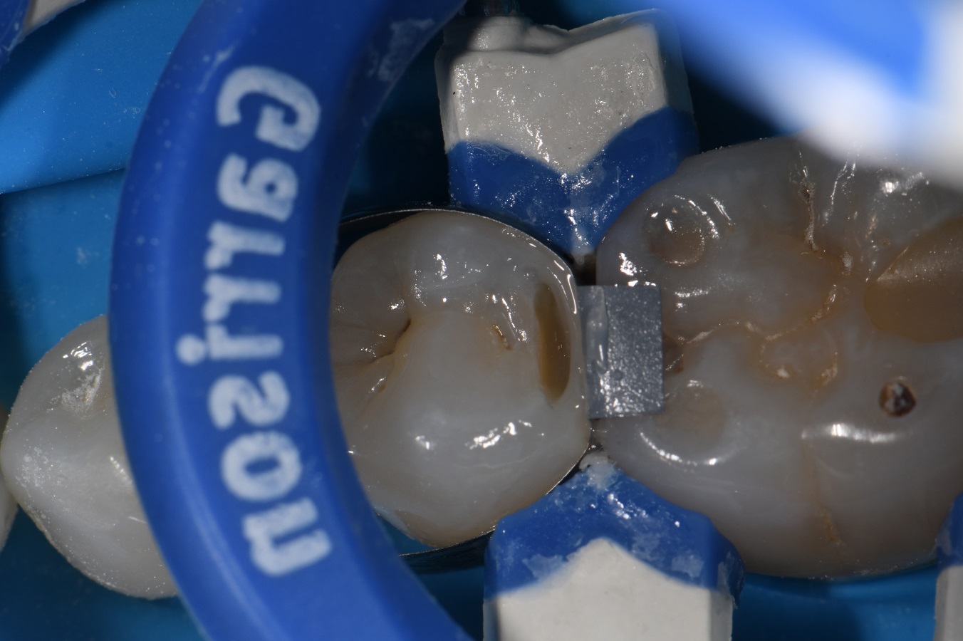 Conservative Slot Composite Restoration Conservative Slot Composite ...