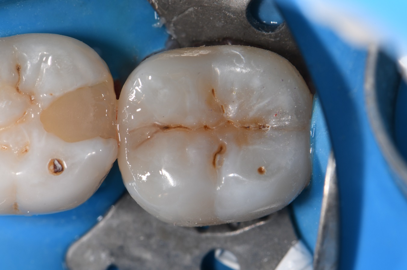 Slot Composite Restoration