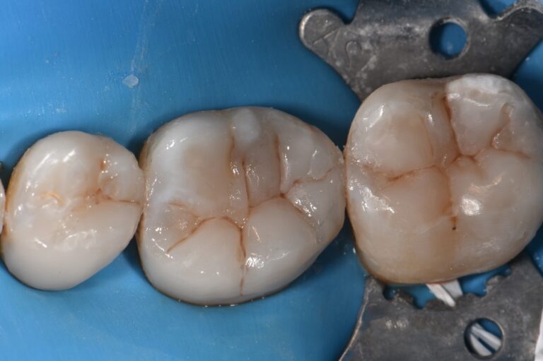 Complex direct composite overlays Complex direct composite overlays