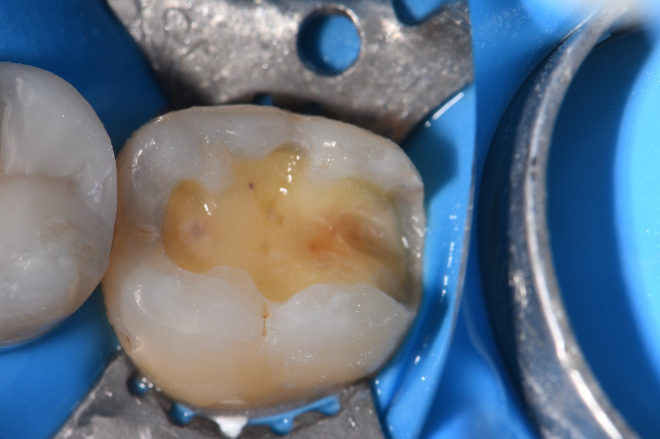 Chasing Cracks In Heavily Restored Teeth Chasing Cracks In Heavily
