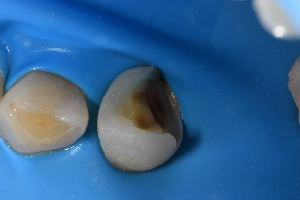 Bicuspid Class Ii Composite Matrix In Matrix