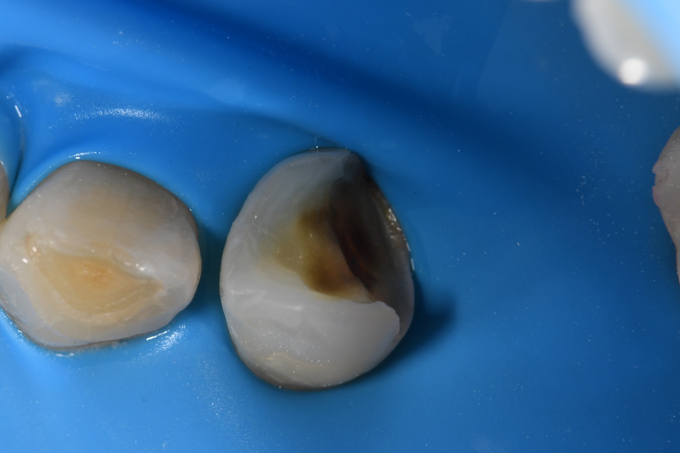 Bicuspid Class II Composite | Matrix in Matrix