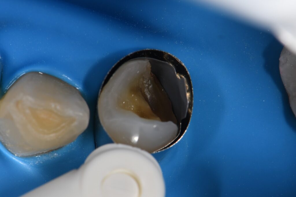 Bicuspid Class Ii Composite Matrix In Matrix