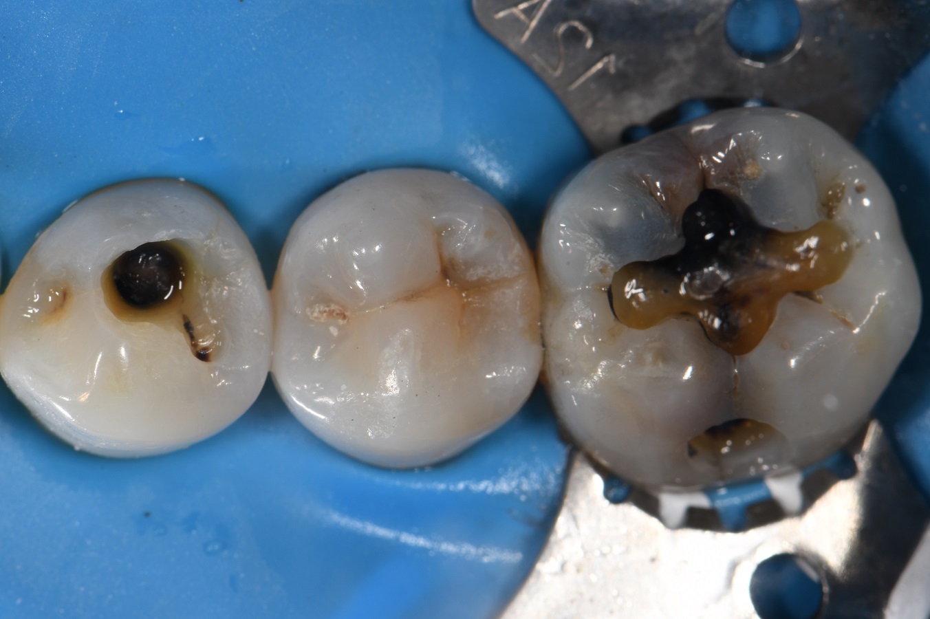 Grey teeth whitened after removal of amalgam