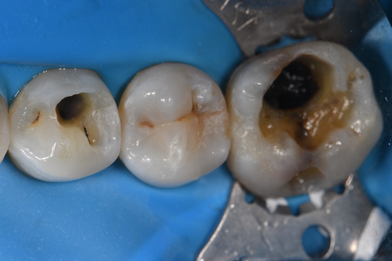 Grey teeth whitened after removal of amalgam