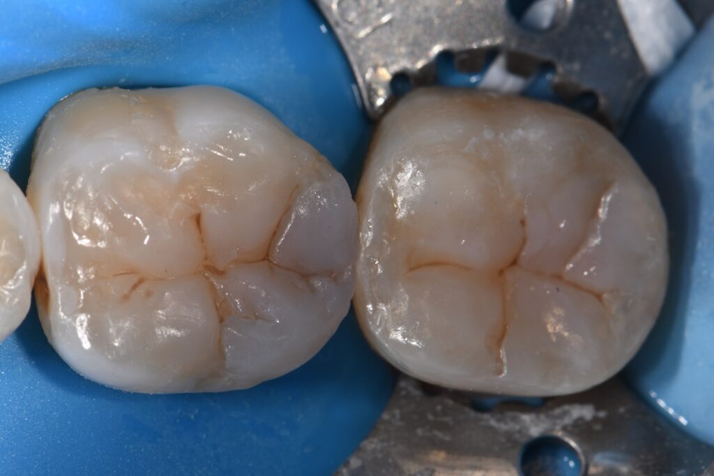Protecting Dental Erosion on Teeth Protecting Dental Erosion on Teeth