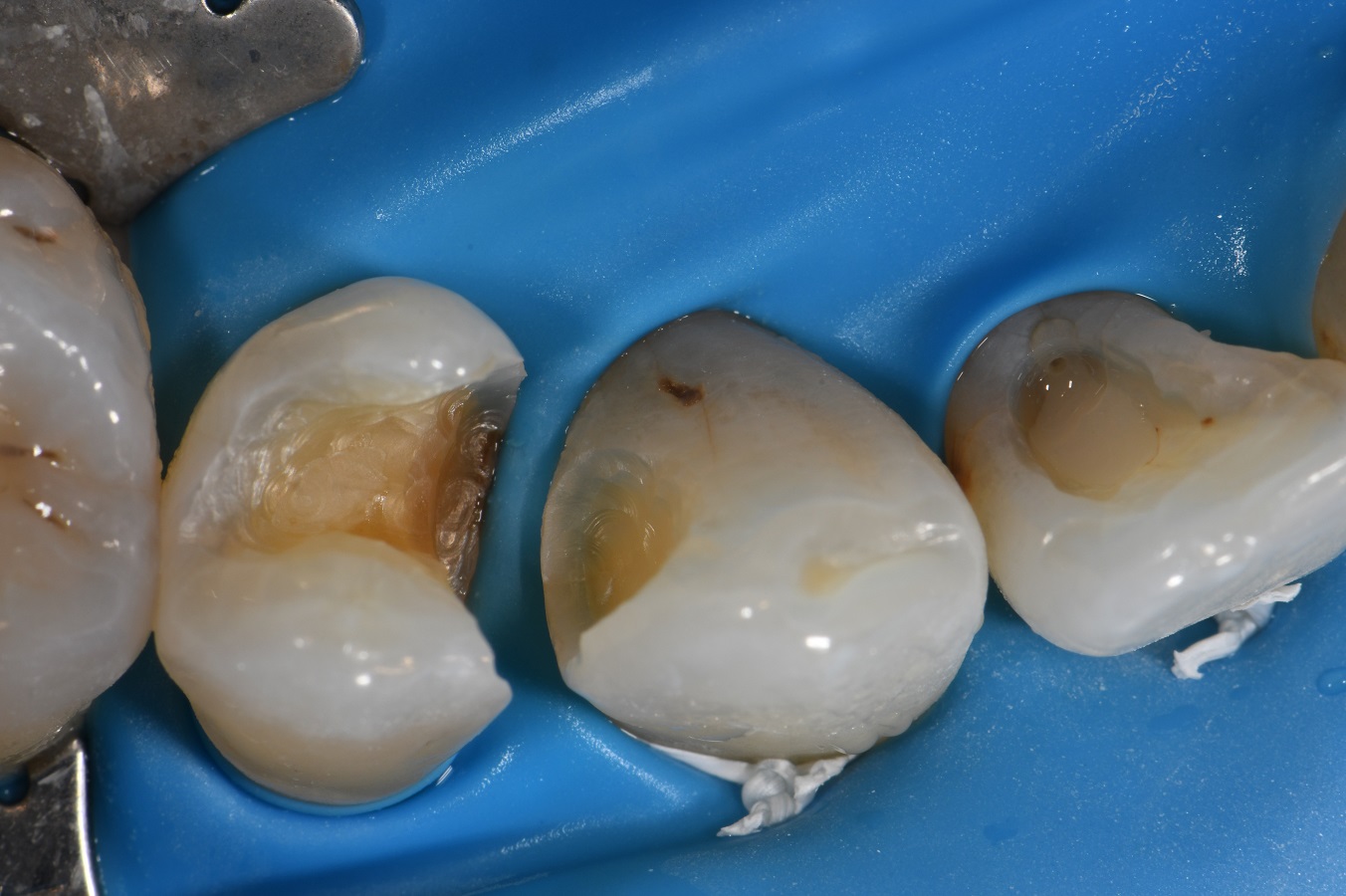 Replacing Old Fillings with Invisible Dentistry
