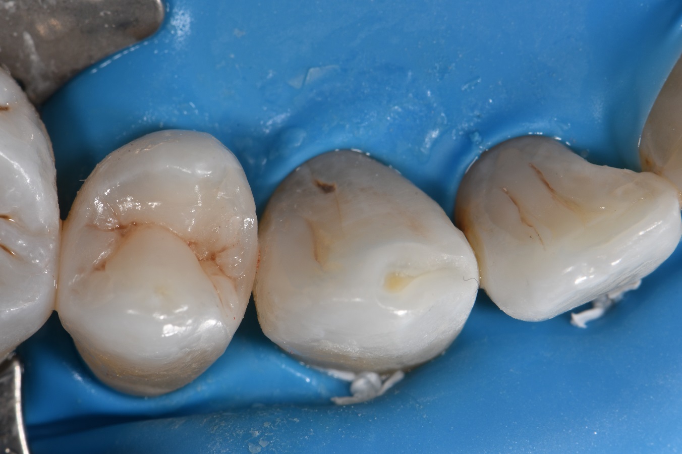 Replacing Old Fillings with Invisible Dentistry