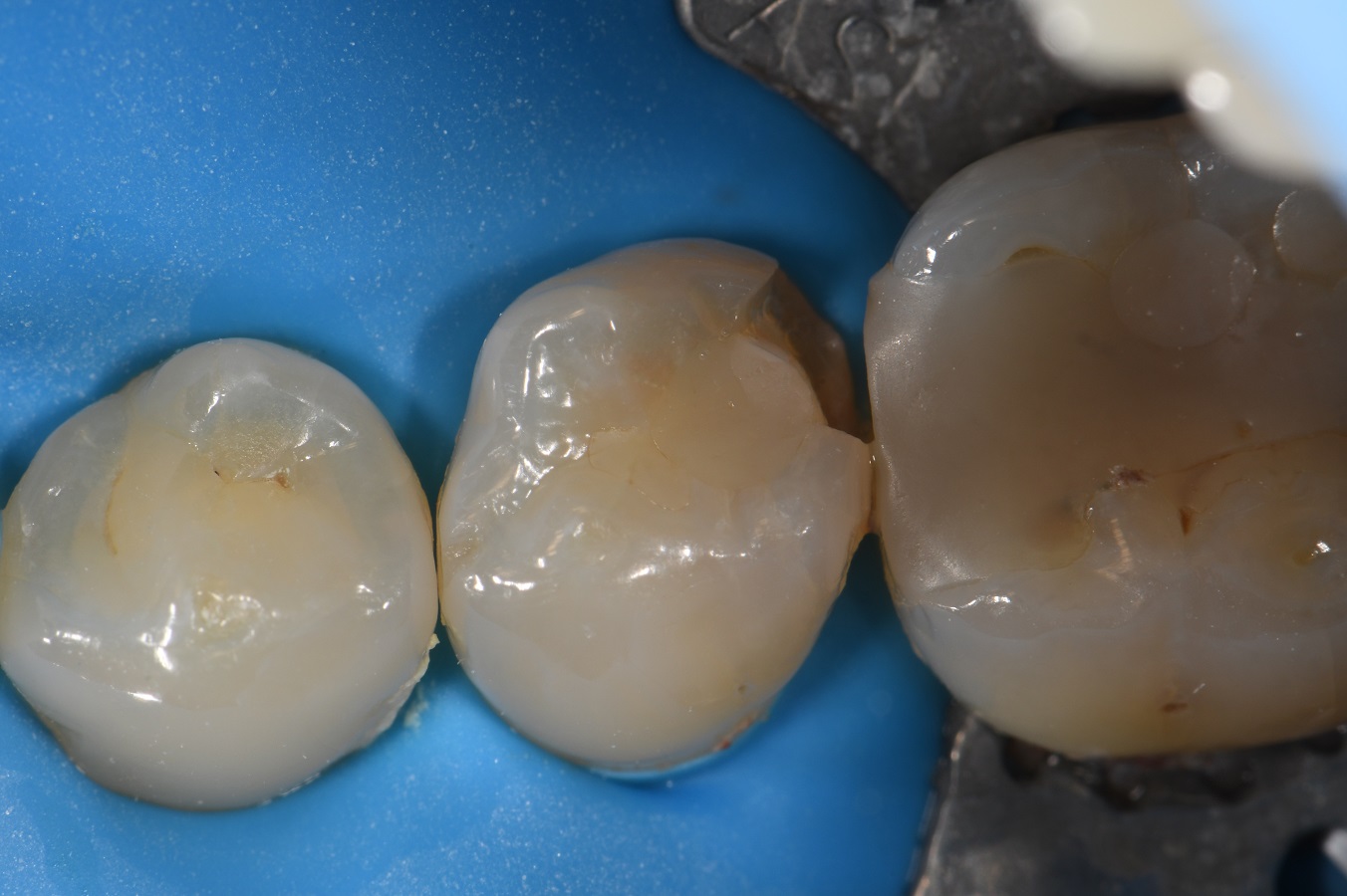 Fractured Composite Replacement Fractured Composite Replacement