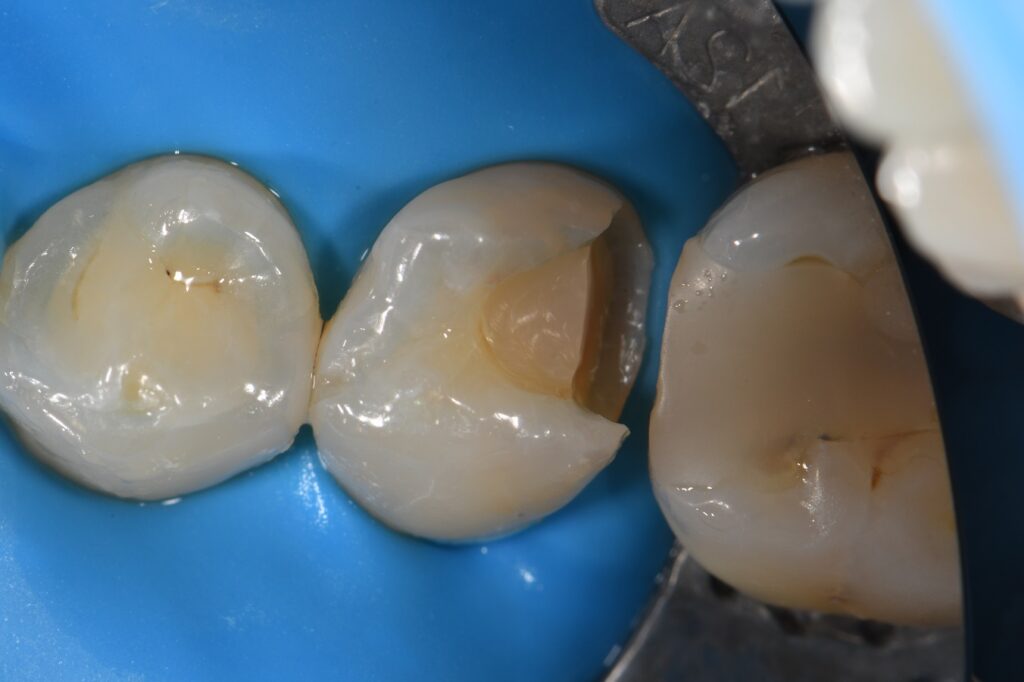 Fractured Composite Replacement Fractured Composite Replacement