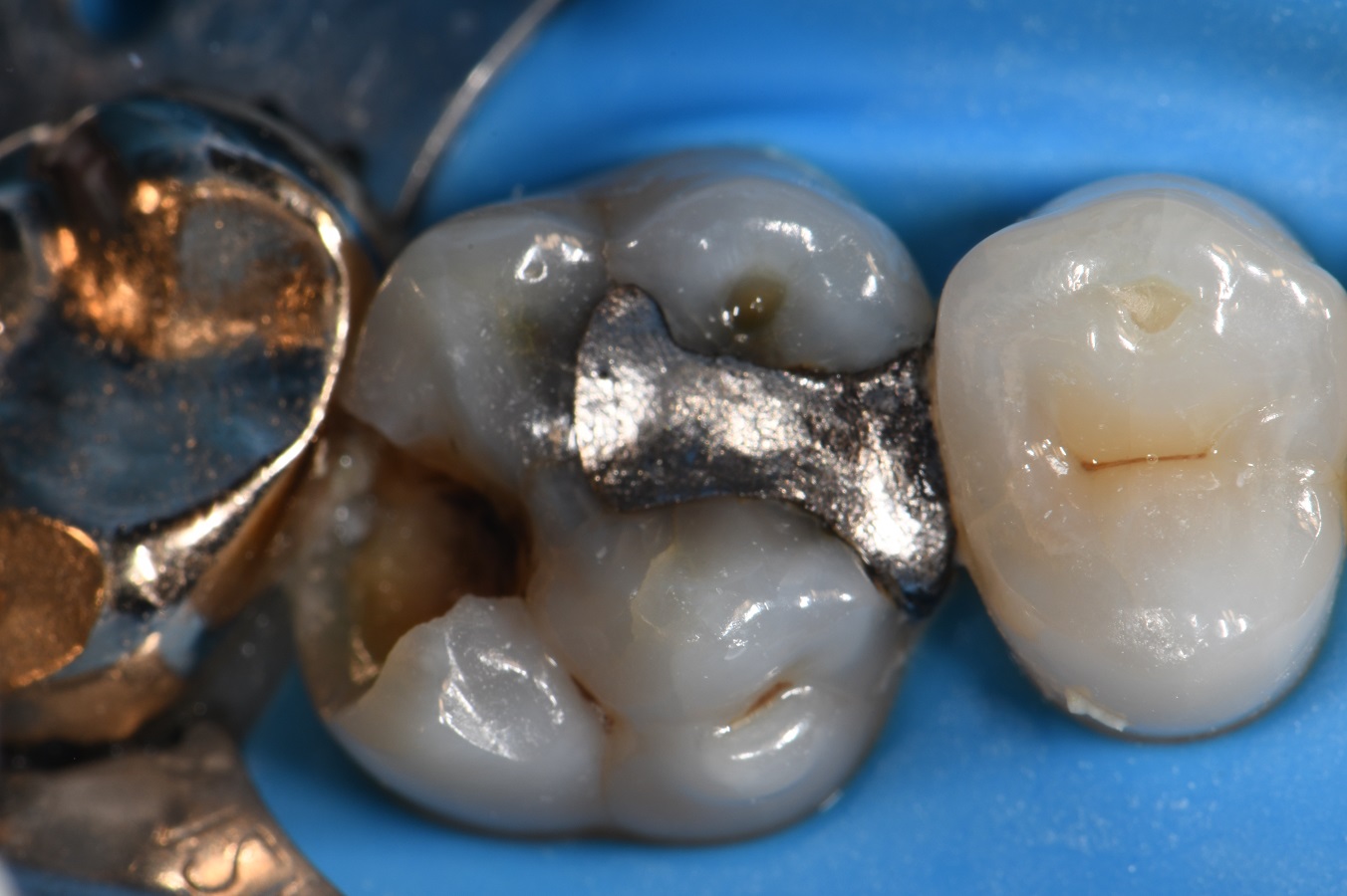 #post_titleAmalgam Replacement with Composite