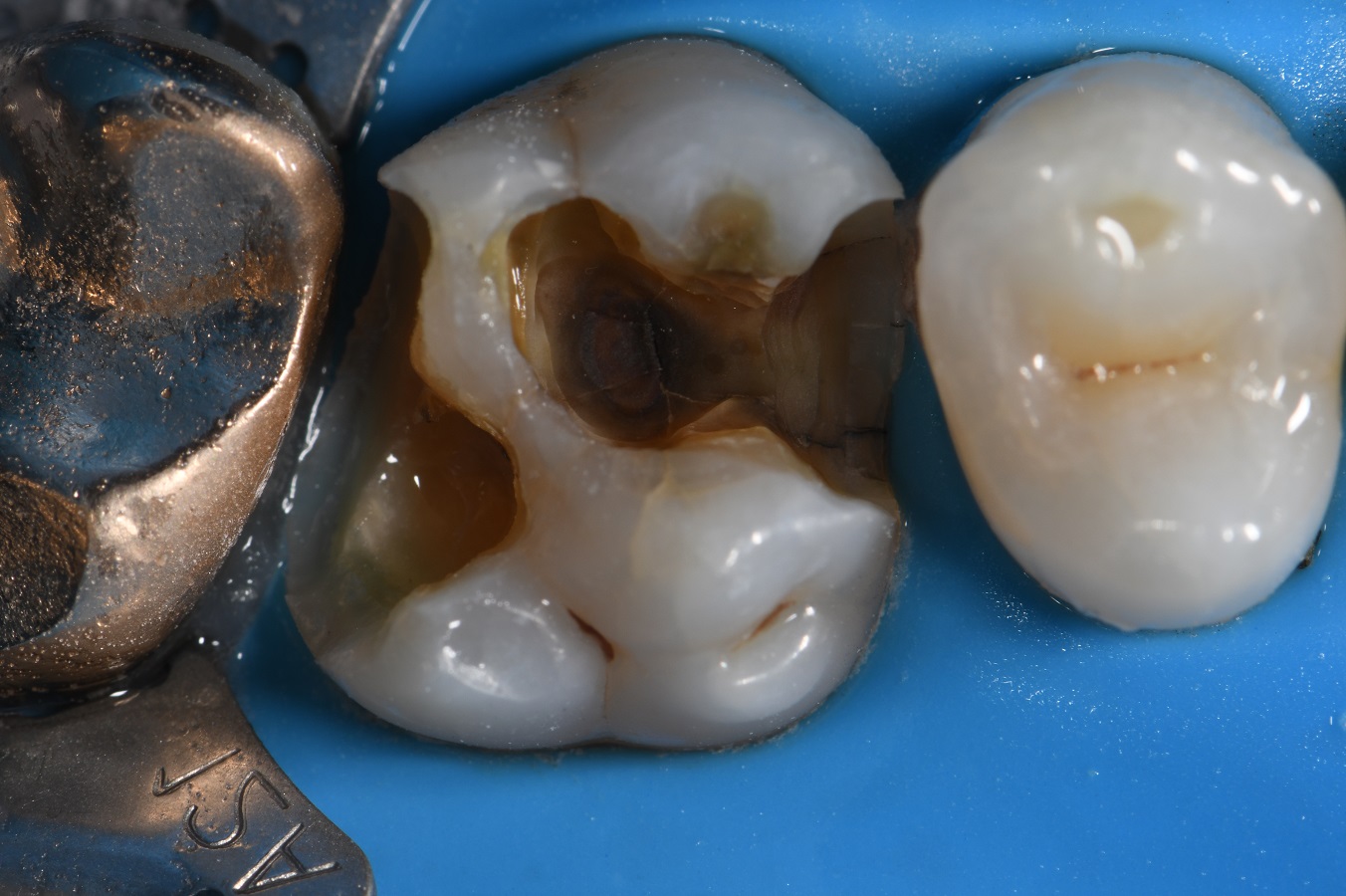 #post_titleAmalgam Replacement with Composite