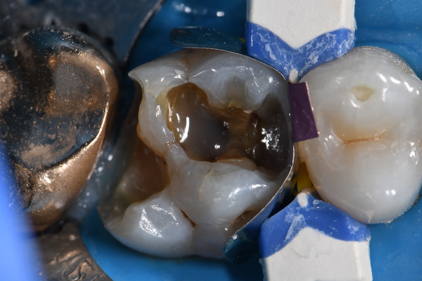 #post_titleAmalgam Replacement with Composite