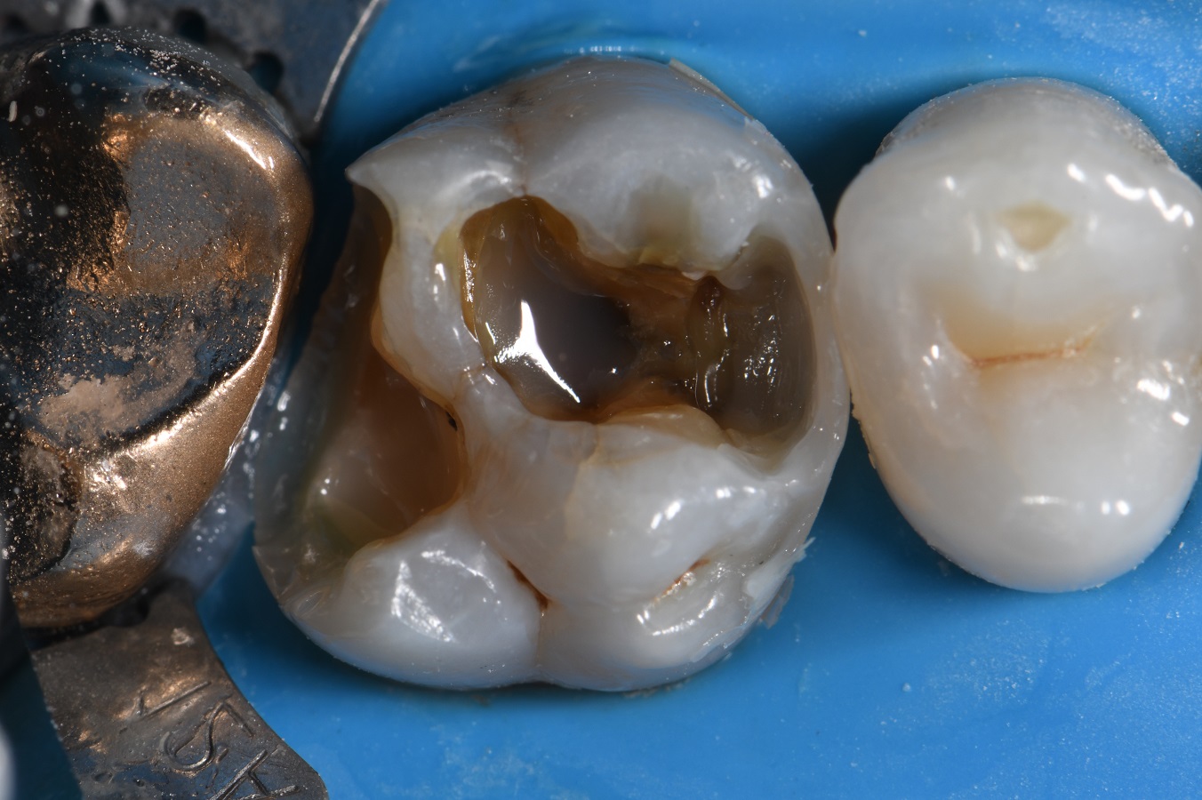 #post_titleAmalgam Replacement with Composite