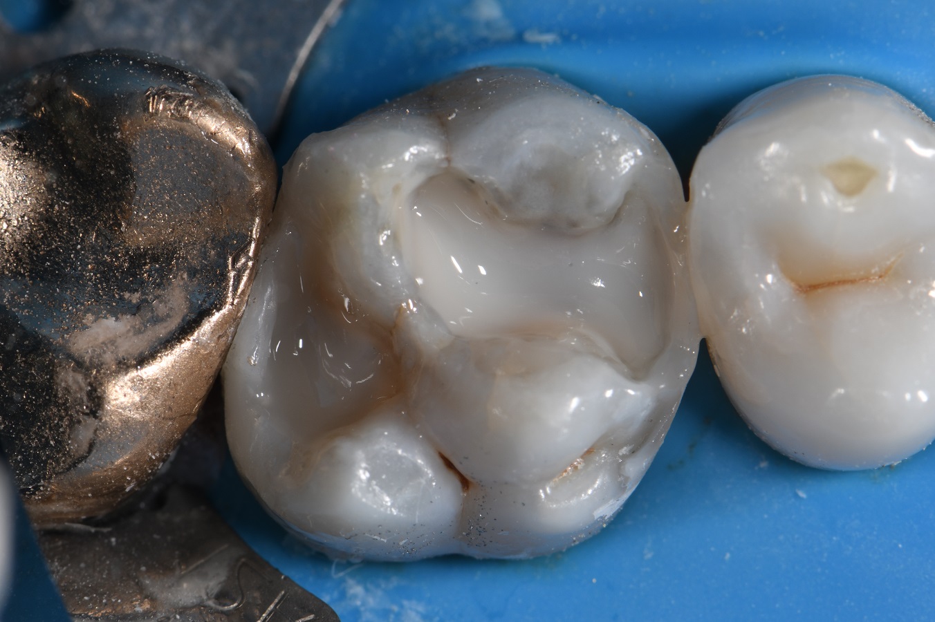 #post_titleAmalgam Replacement with Composite