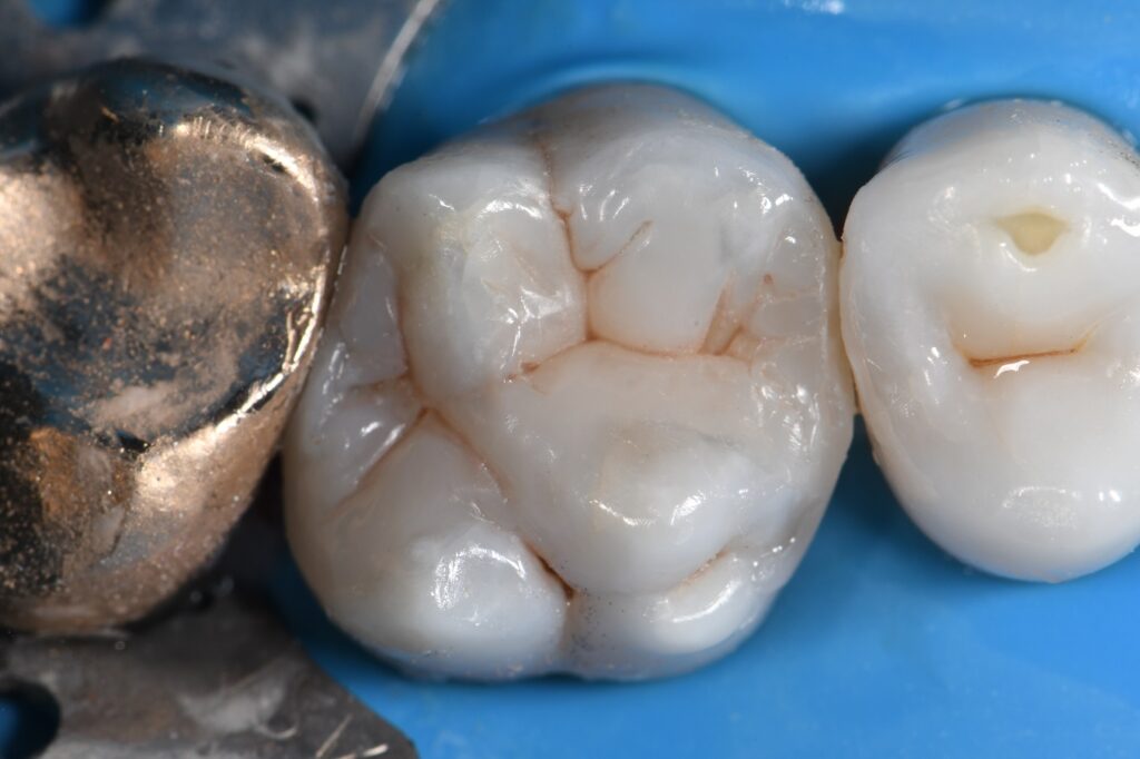 #post_titleAmalgam Replacement with Composite