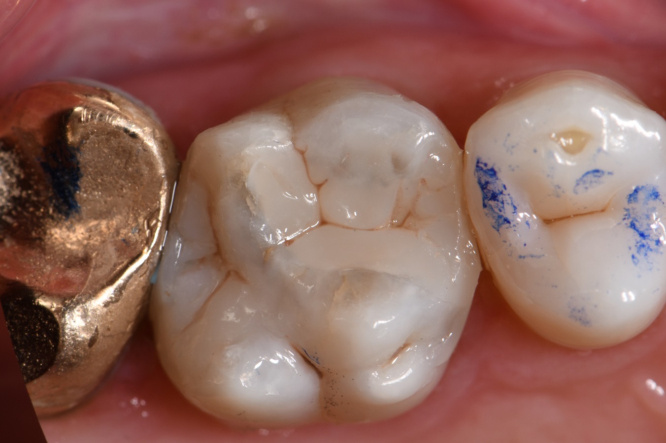 #post_titleAmalgam Replacement with Composite