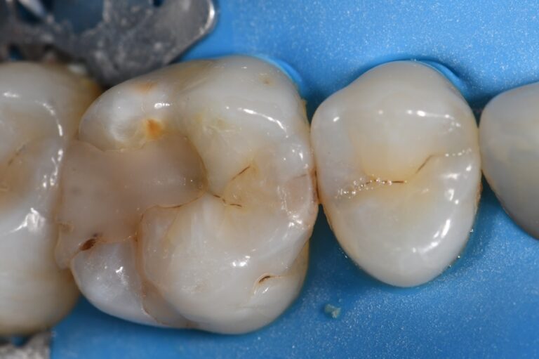 Composite Artistry Premolar Molar Composite Artistry Premolar Molar