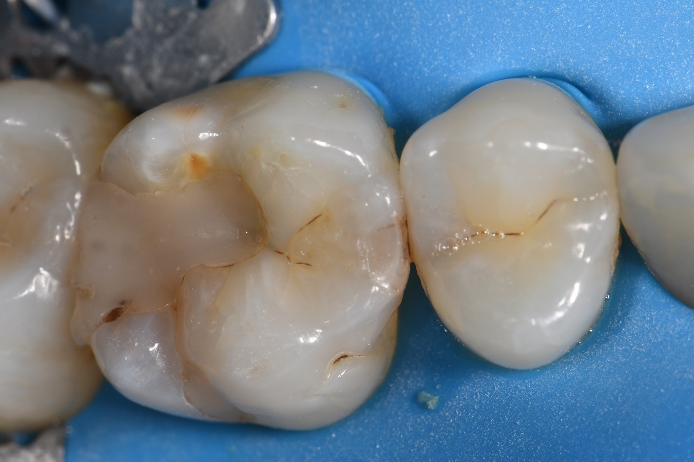 Composite Artistry Premolar Molar Composite Artistry Premolar Molar