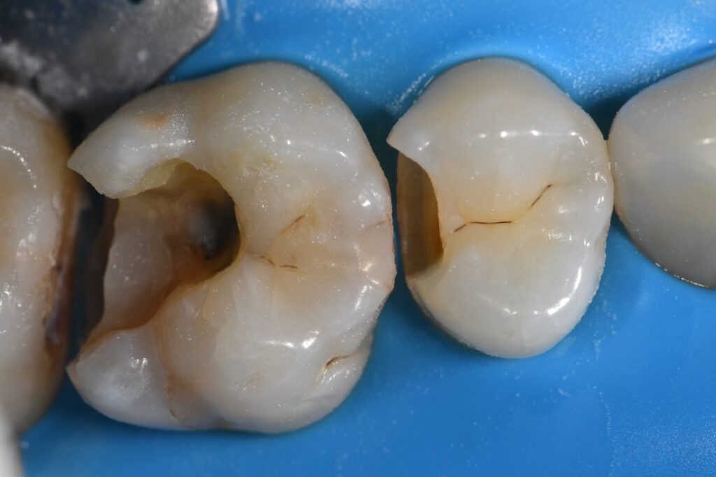 Composite Artistry Premolar Molar Composite Artistry Premolar Molar