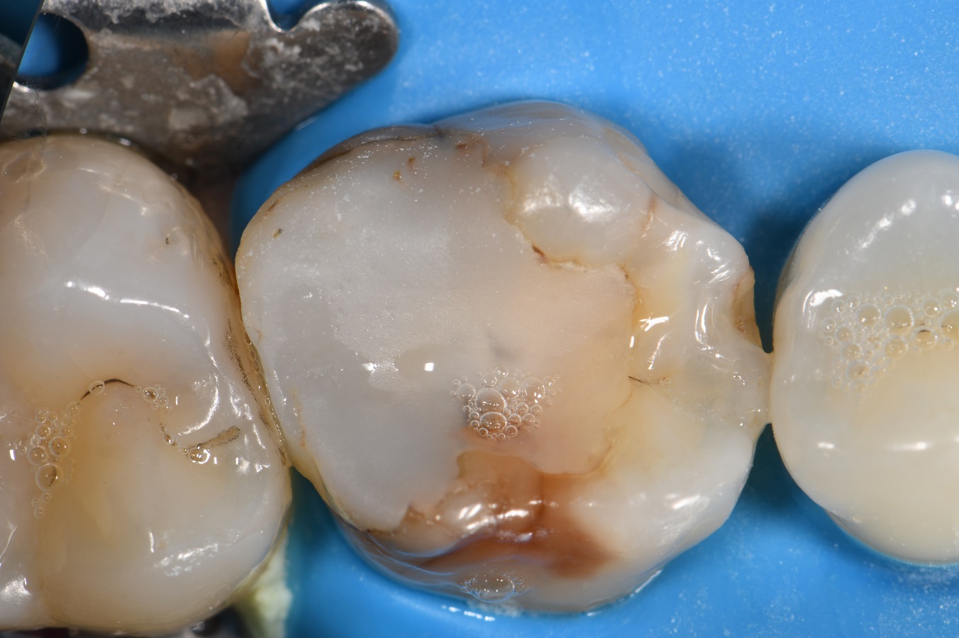 Conservative Direct Complex Composite | Molar Hypomin Conservative ...