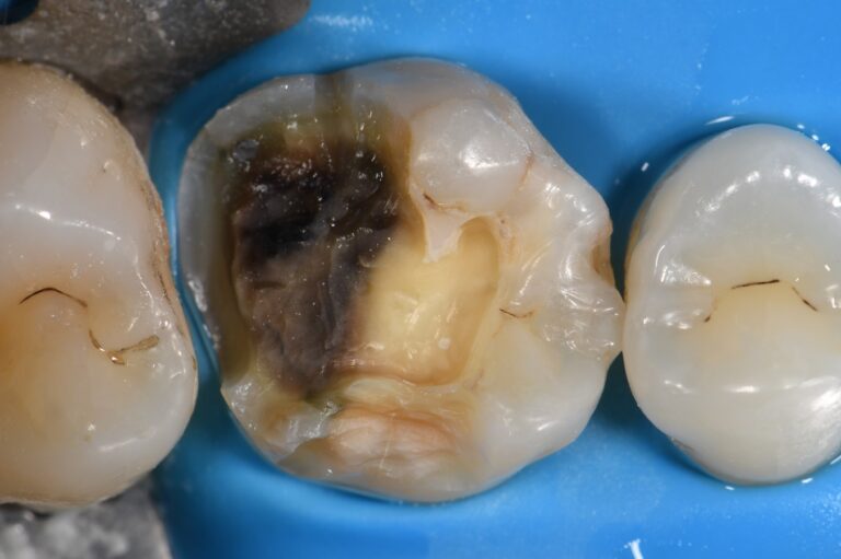 Conservative Direct Complex Composite | Molar Hypomin Conservative ...