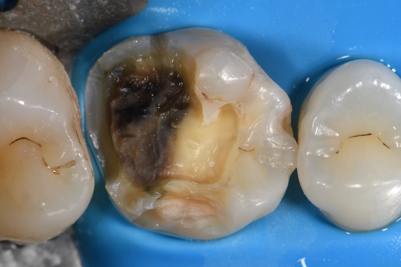 Conservative Direct Complex Composite | Molar Hypomin Conservative ...