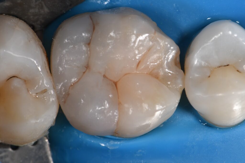 Conservative Direct Complex Composite | Molar Hypomin Conservative ...