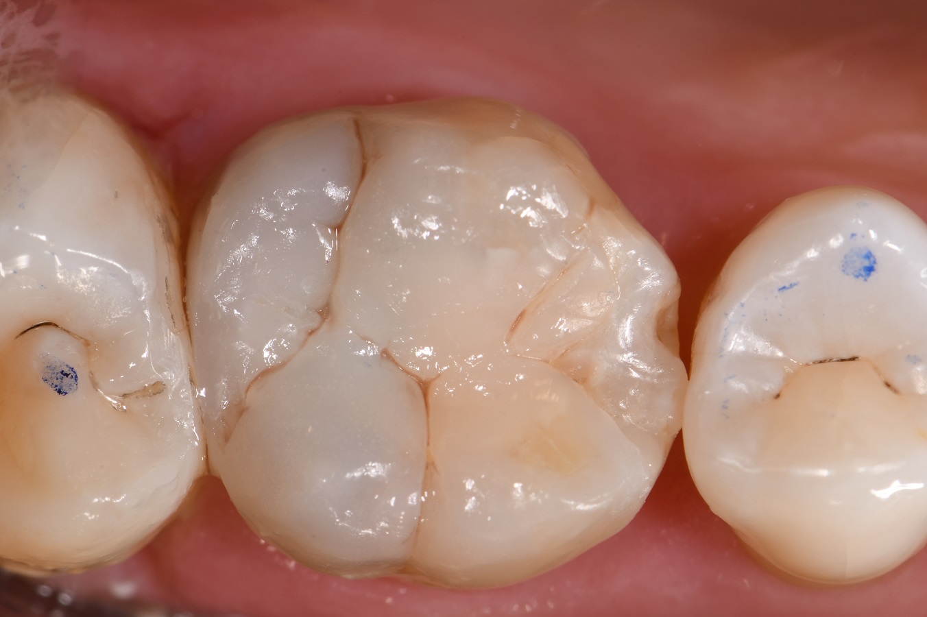 Conservative Direct Complex Composite | Molar Hypomin Conservative ...