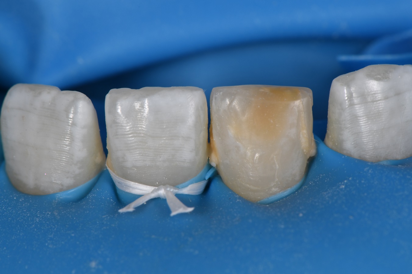 Composite Veneer | Incisor Yellow Spot | Hypomin