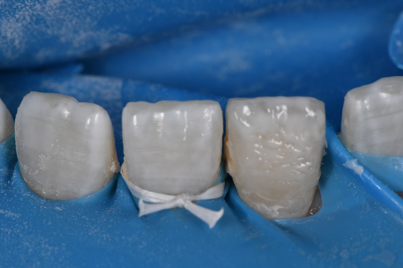 Composite Veneer | Incisor Yellow Spot | Hypomin