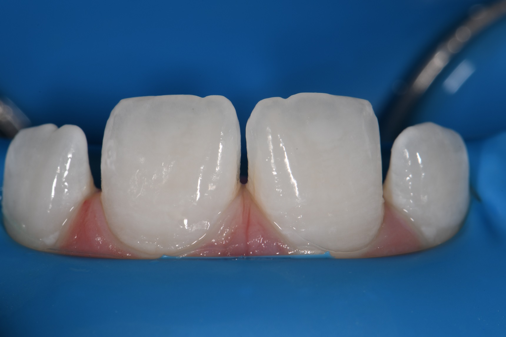 Resin Infiltration | Incisor Hypomineralization