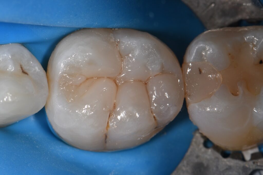 Kuraray Majesty ES-2 Universal UL Kuraray Majesty ES-2 Universal UL