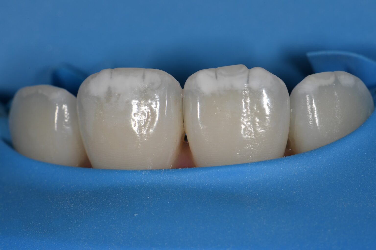 Resin Infiltration | Incisor Hypocalcification