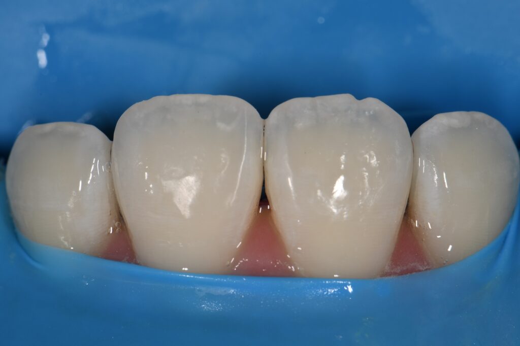 Resin Infiltration | Incisor Hypocalcification