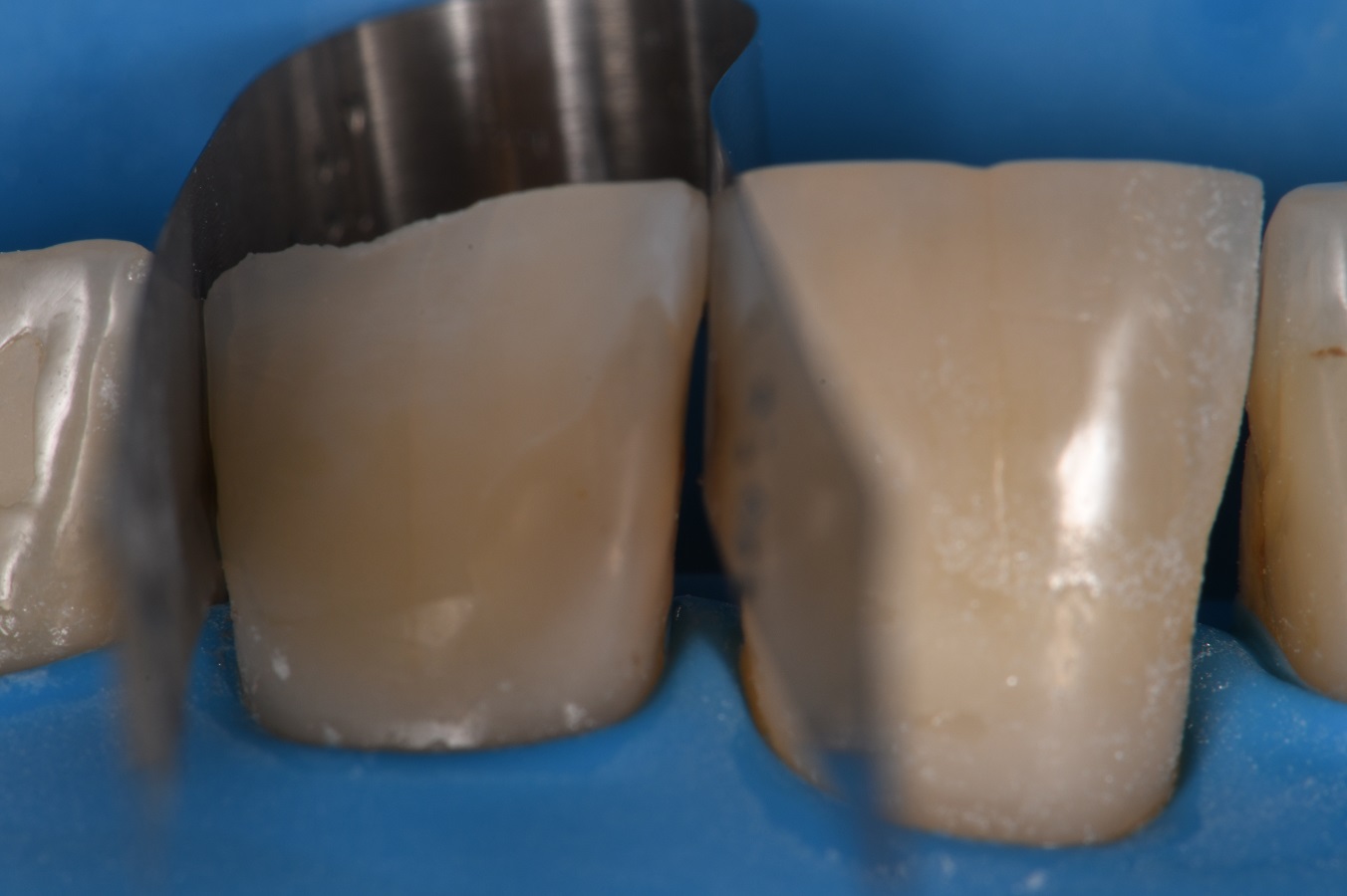Enamel Fracture Repaired Voco Amaris Enamel Fracture Repaired Voco Amaris