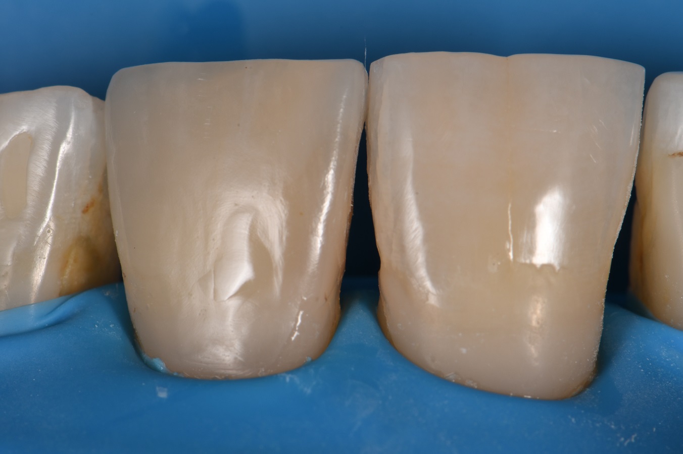 Enamel Fracture Repaired Voco Amaris Enamel Fracture Repaired Voco Amaris