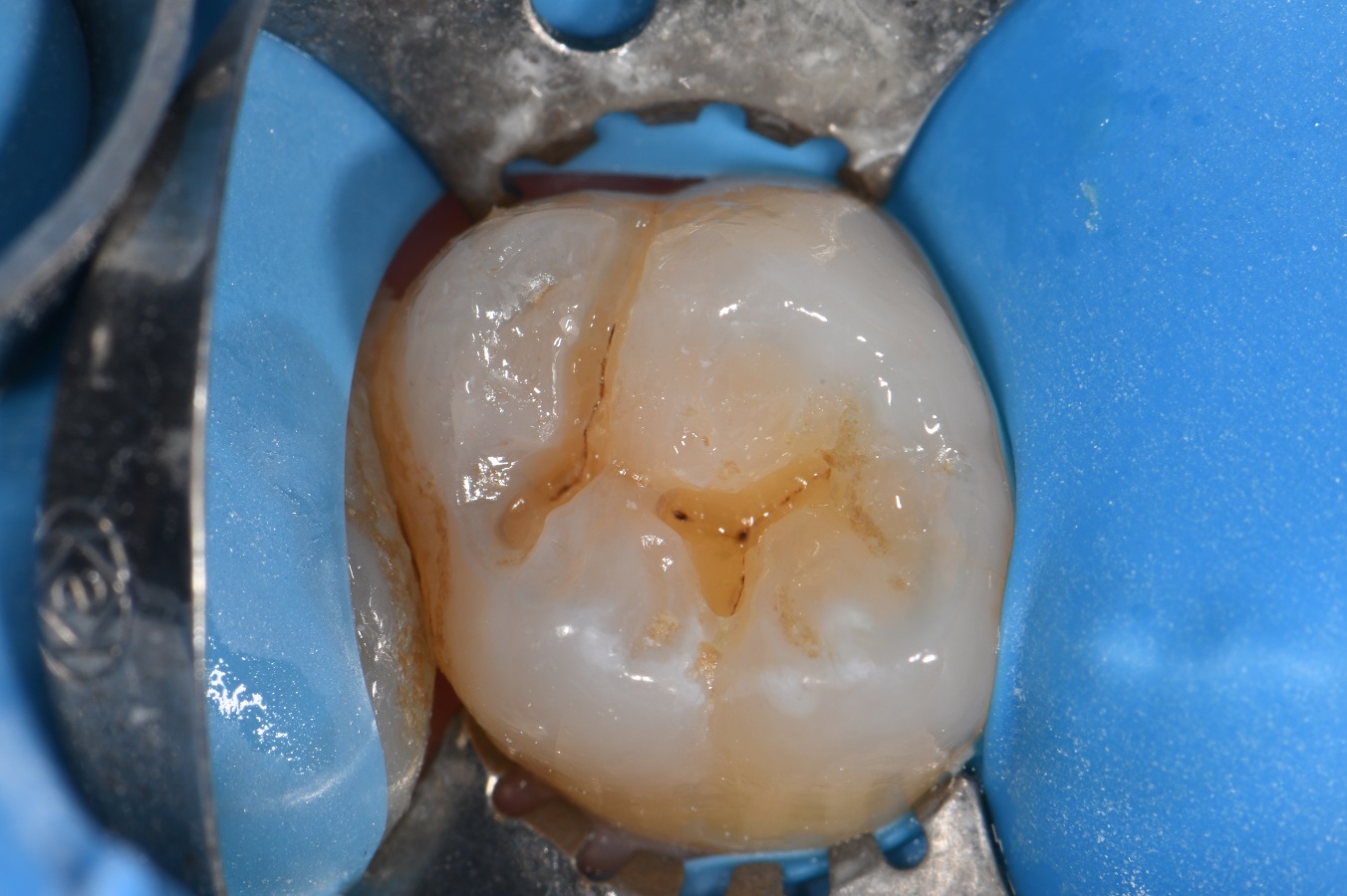 Fissure Sealants that become Cavities