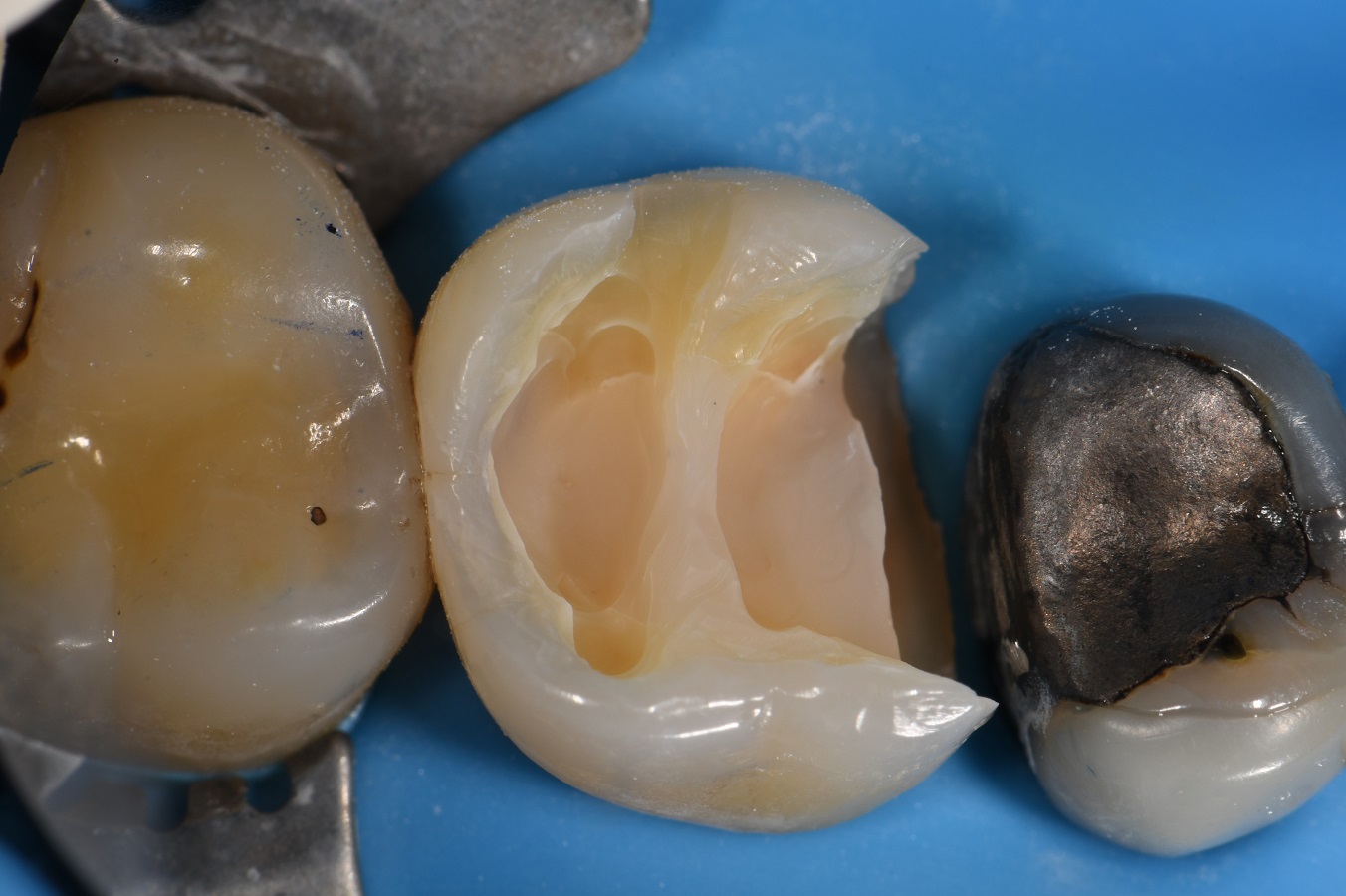 Garrison Dental Wide Prep Ring Class II Solution