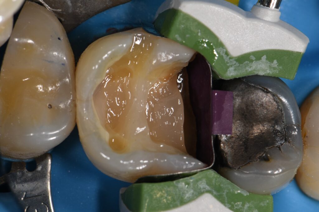 Garrison Dental Wide Prep Ring Class II Solution