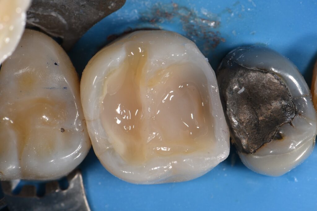 Garrison Dental Wide Prep Ring Class II Solution