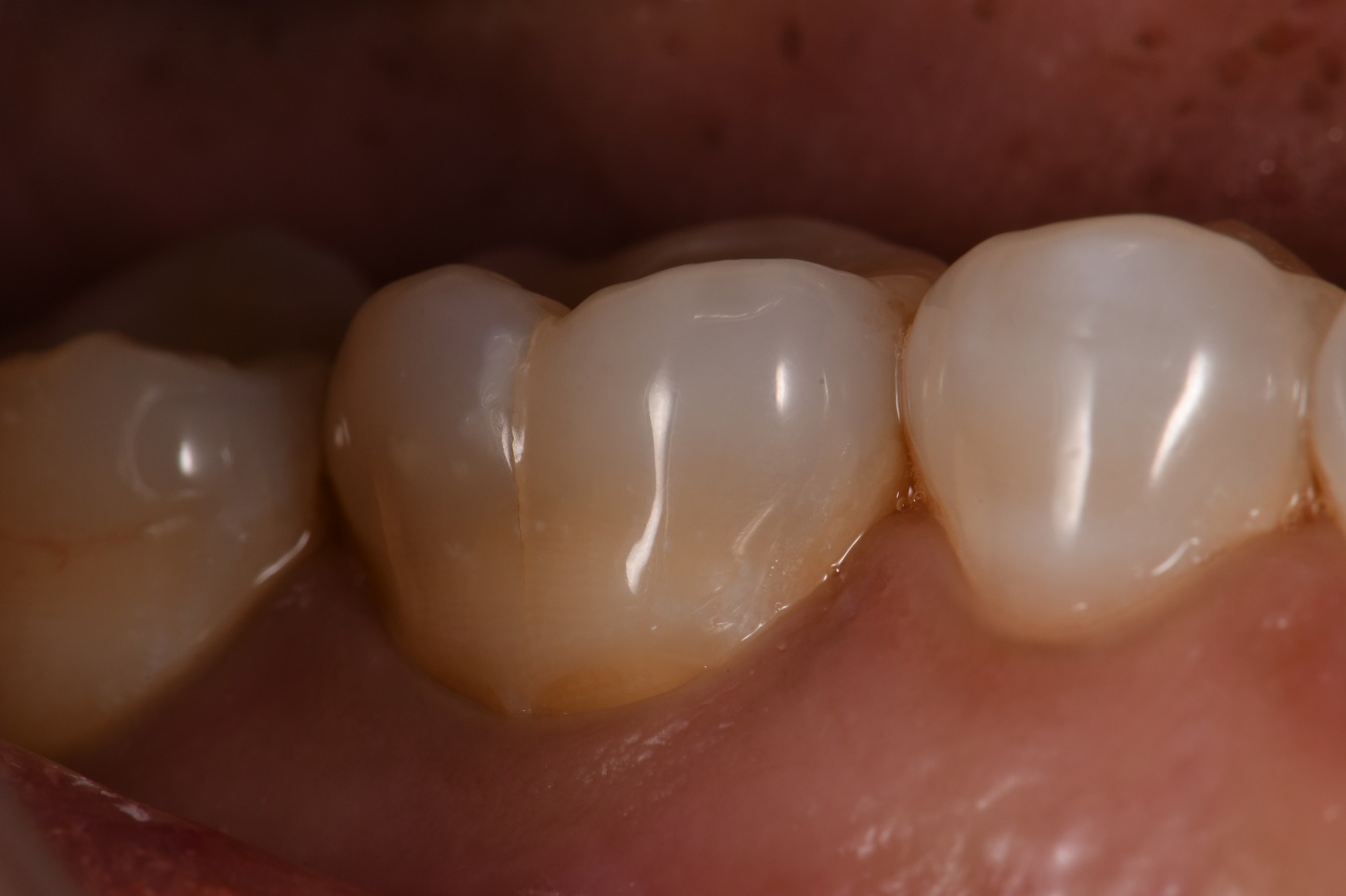 The small cervical abrasion lesions The small cervical abrasion lesions