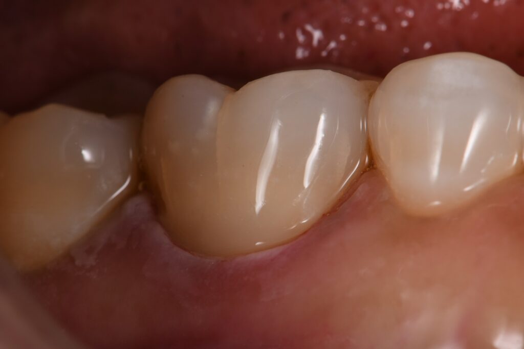 The small cervical abrasion lesions The small cervical abrasion lesions